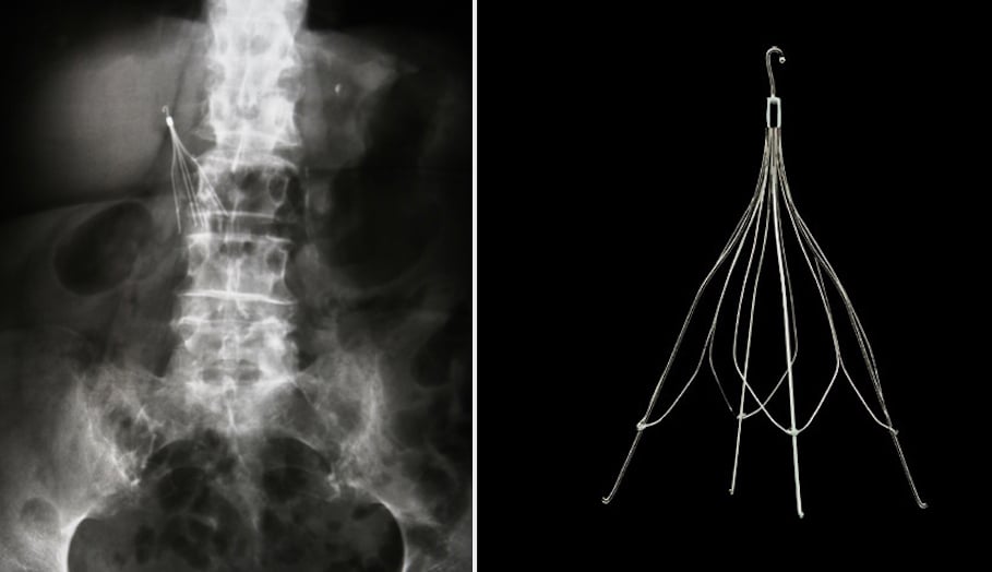greenfield filter placement